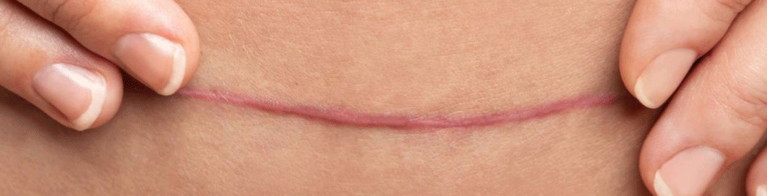 Scar Therapy - Cheshire Pelvic Health Physiotherapy